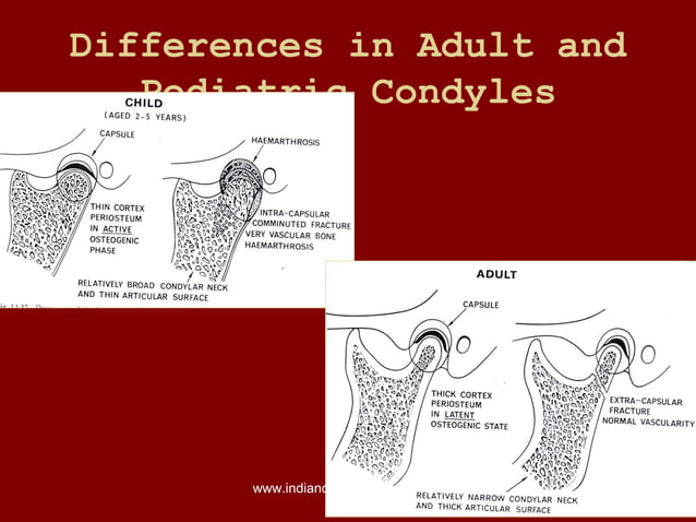 Condylar fractures /certified fixed orthodontic courses by Indian ...