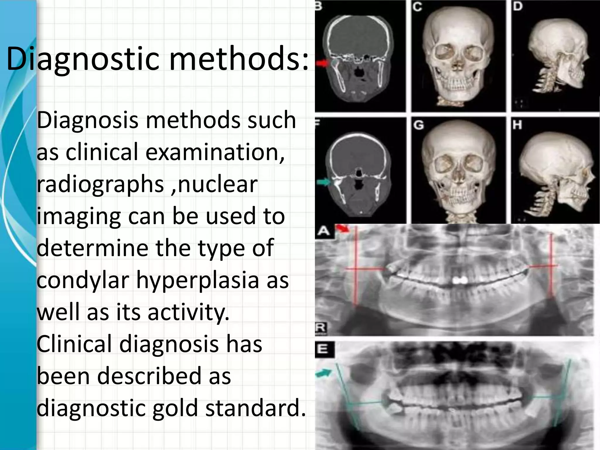 Condylar hyperplasia by DR SOONHAN ABDULLAH AND DR SALMAN SHAMS (MSc ...
