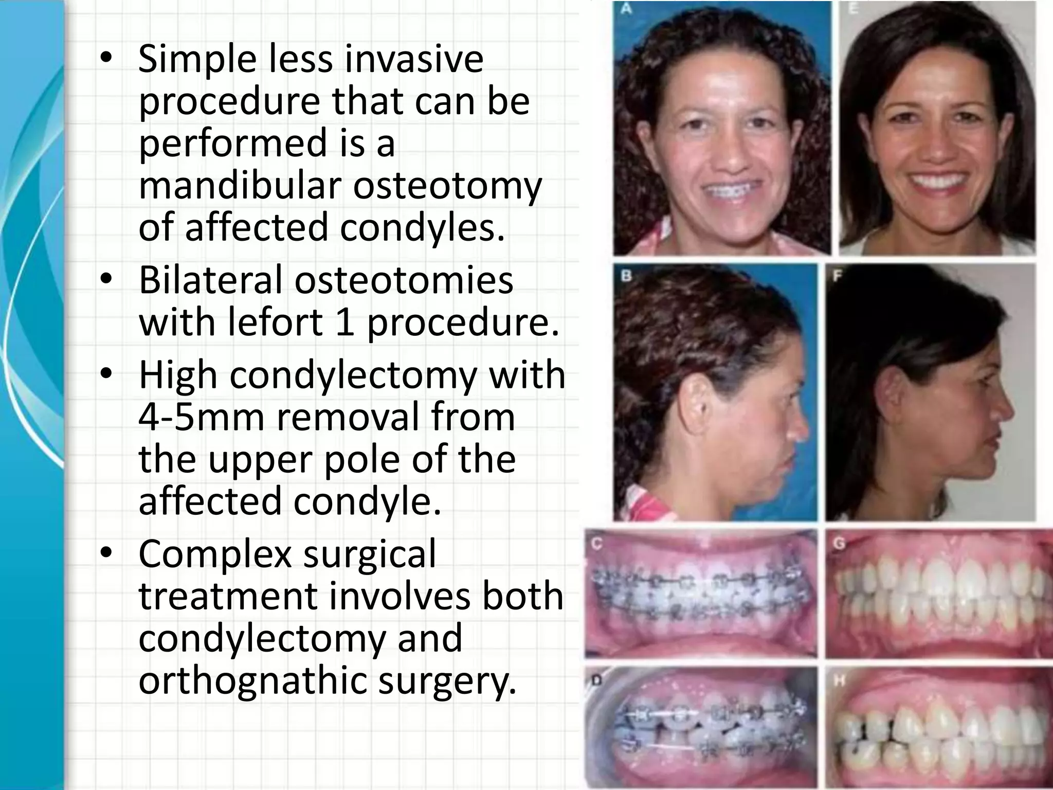 Condylar hyperplasia by DR SOONHAN ABDULLAH AND DR SALMAN SHAMS (MSc ...