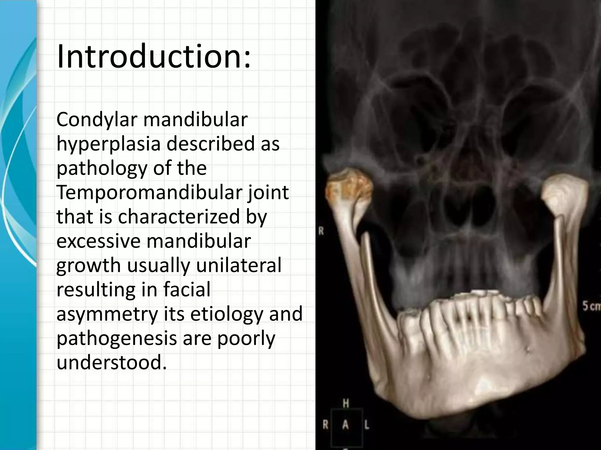 Condylar hyperplasia by DR SOONHAN ABDULLAH AND DR SALMAN SHAMS (MSc ...