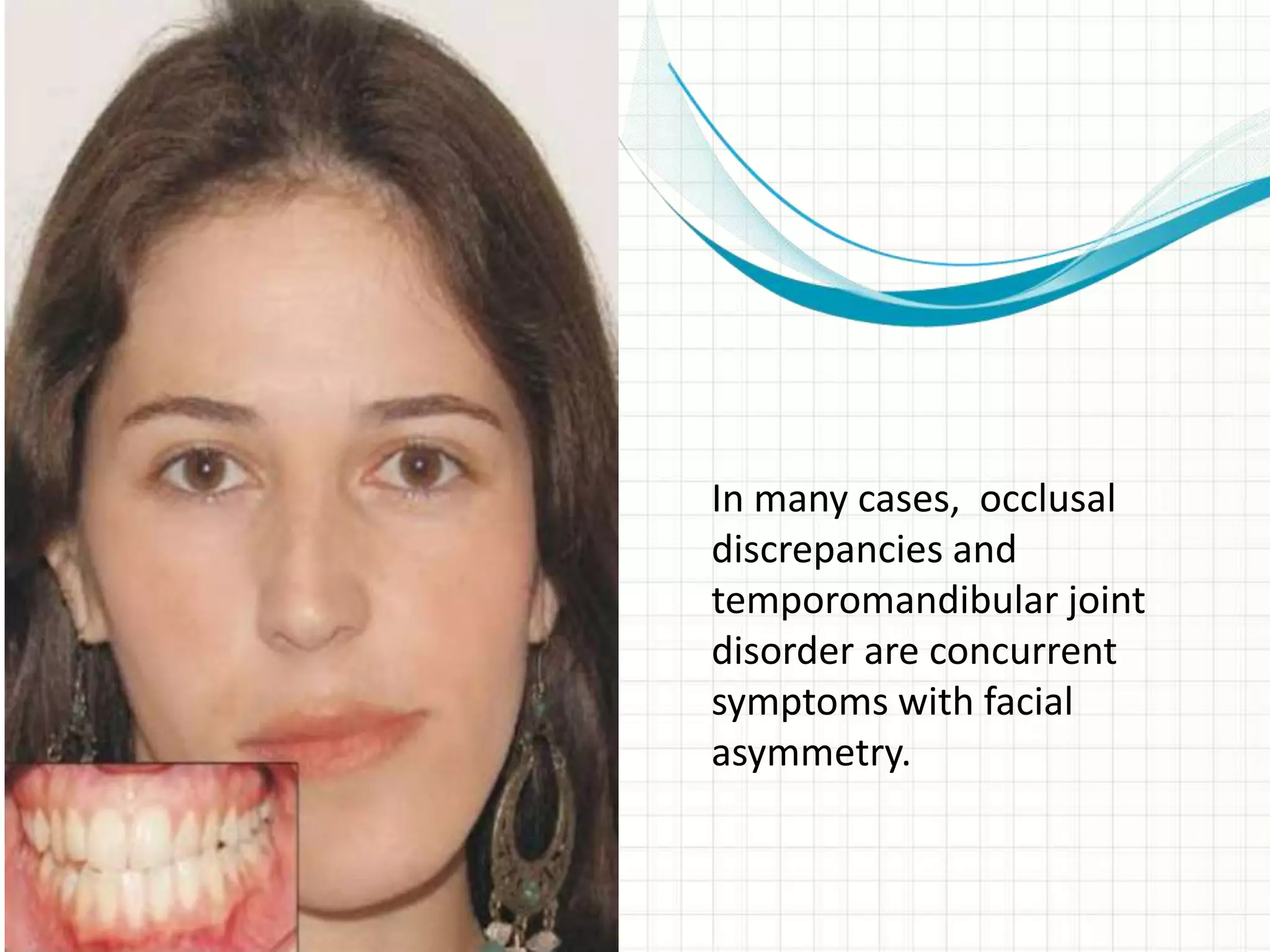 Condylar hyperplasia by DR SOONHAN ABDULLAH AND DR SALMAN SHAMS (MSc ...