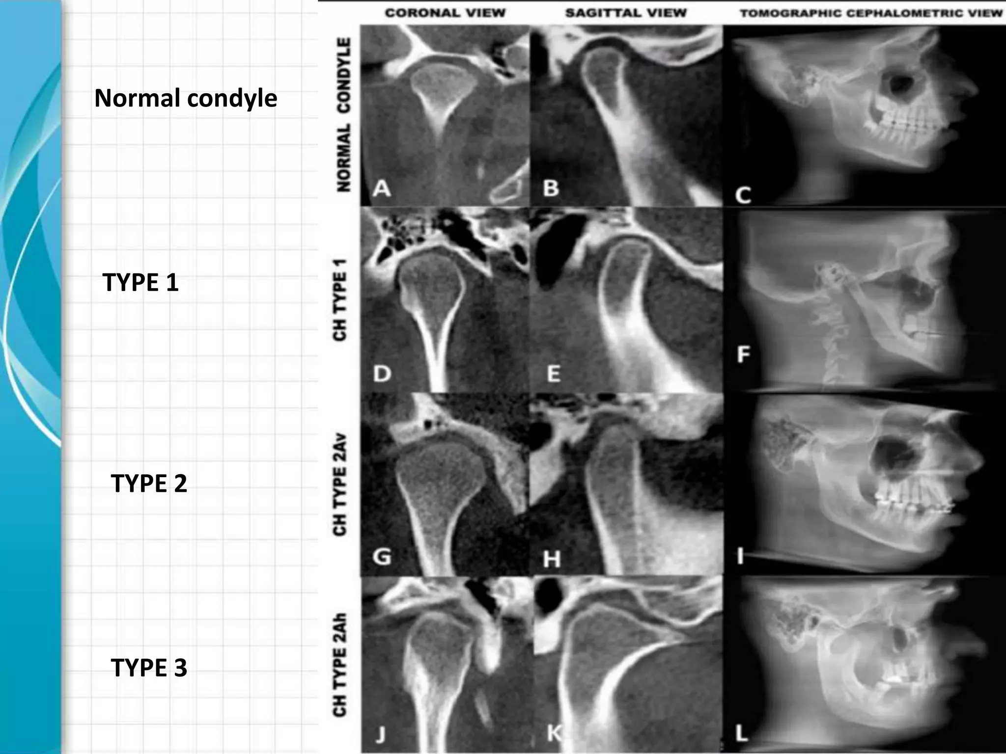 Condylar hyperplasia by DR SOONHAN ABDULLAH AND DR SALMAN SHAMS (MSc ...