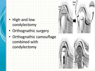 Condylar hyperplasia by DR SOONHAN ABDULLAH AND DR SALMAN SHAMS (MSc ...