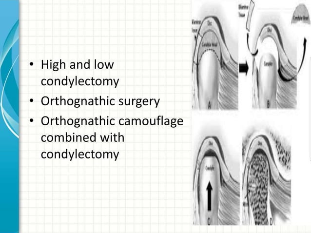 Condylar hyperplasia by DR SOONHAN ABDULLAH AND DR SALMAN SHAMS (MSc ...