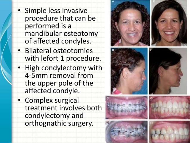 Condylar hyperplasia by DR SOONHAN ABDULLAH AND DR SALMAN SHAMS (MSc ...
