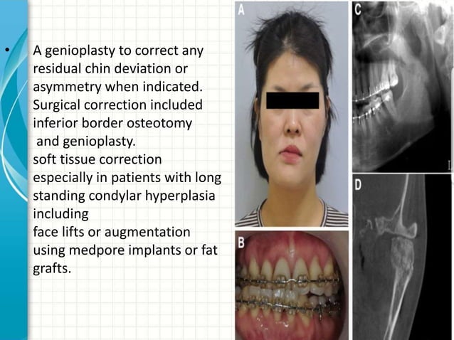 Condylar hyperplasia by DR SOONHAN ABDULLAH AND DR SALMAN SHAMS (MSc ...
