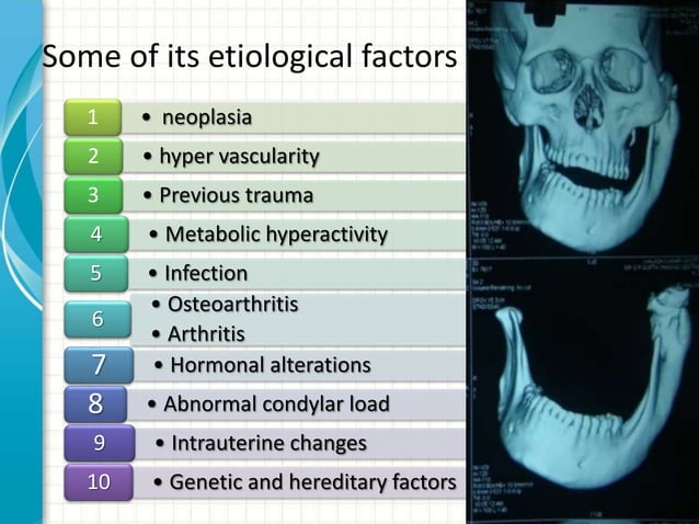 Condylar hyperplasia by DR SOONHAN ABDULLAH AND DR SALMAN SHAMS (MSc ...