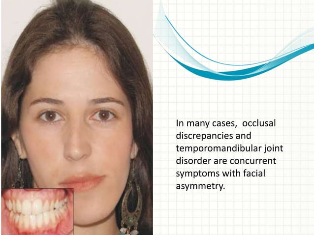 Condylar hyperplasia by DR SOONHAN ABDULLAH AND DR SALMAN SHAMS (MSc ...