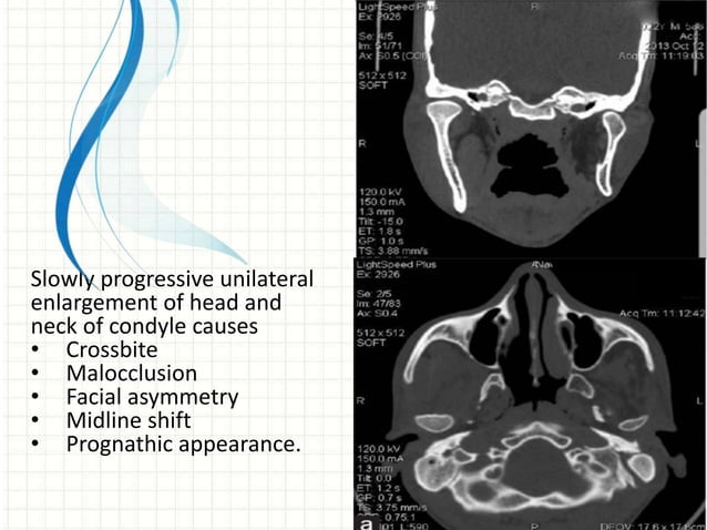 Condylar hyperplasia by DR SOONHAN ABDULLAH AND DR SALMAN SHAMS (MSc ...