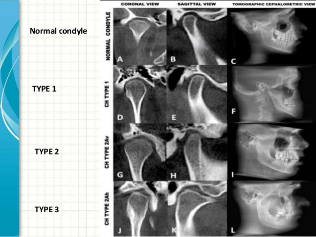 Condylar hyperplasia by DR SOONHAN ABDULLAH AND DR SALMAN SHAMS (MSc