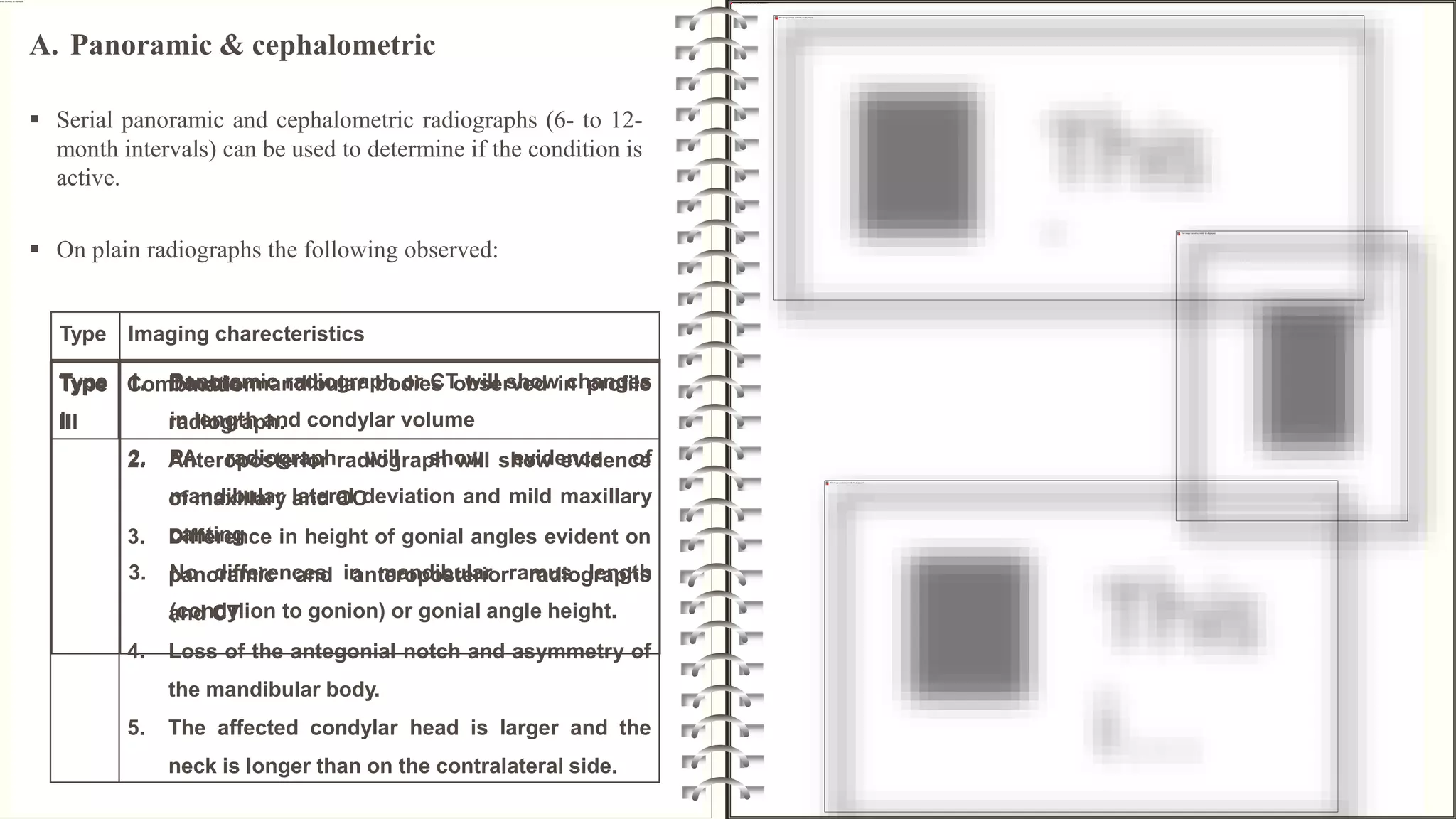 Condylar Hyperplasia and Othodontics.pptx