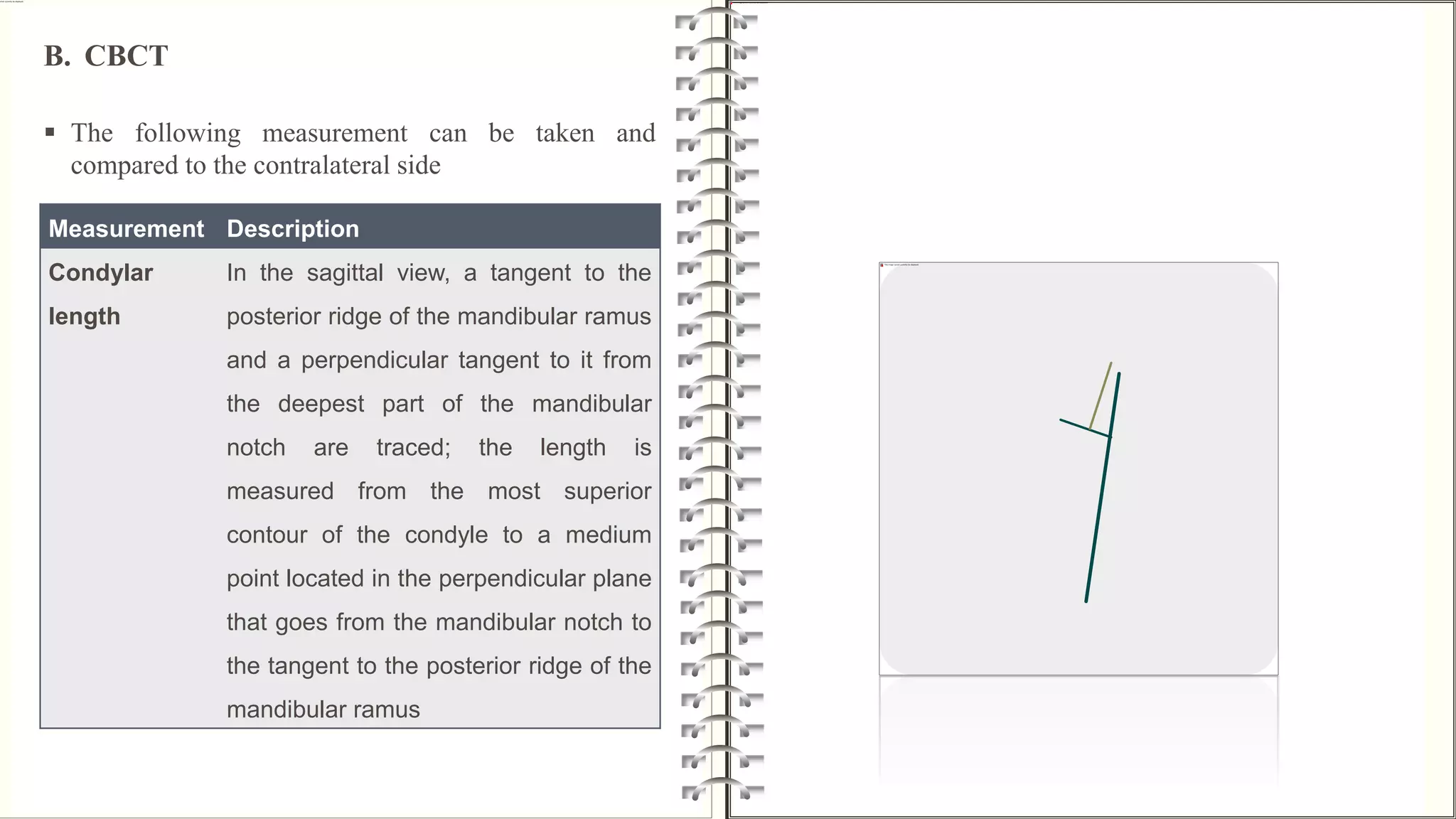 Condylar Hyperplasia and Othodontics.pptx