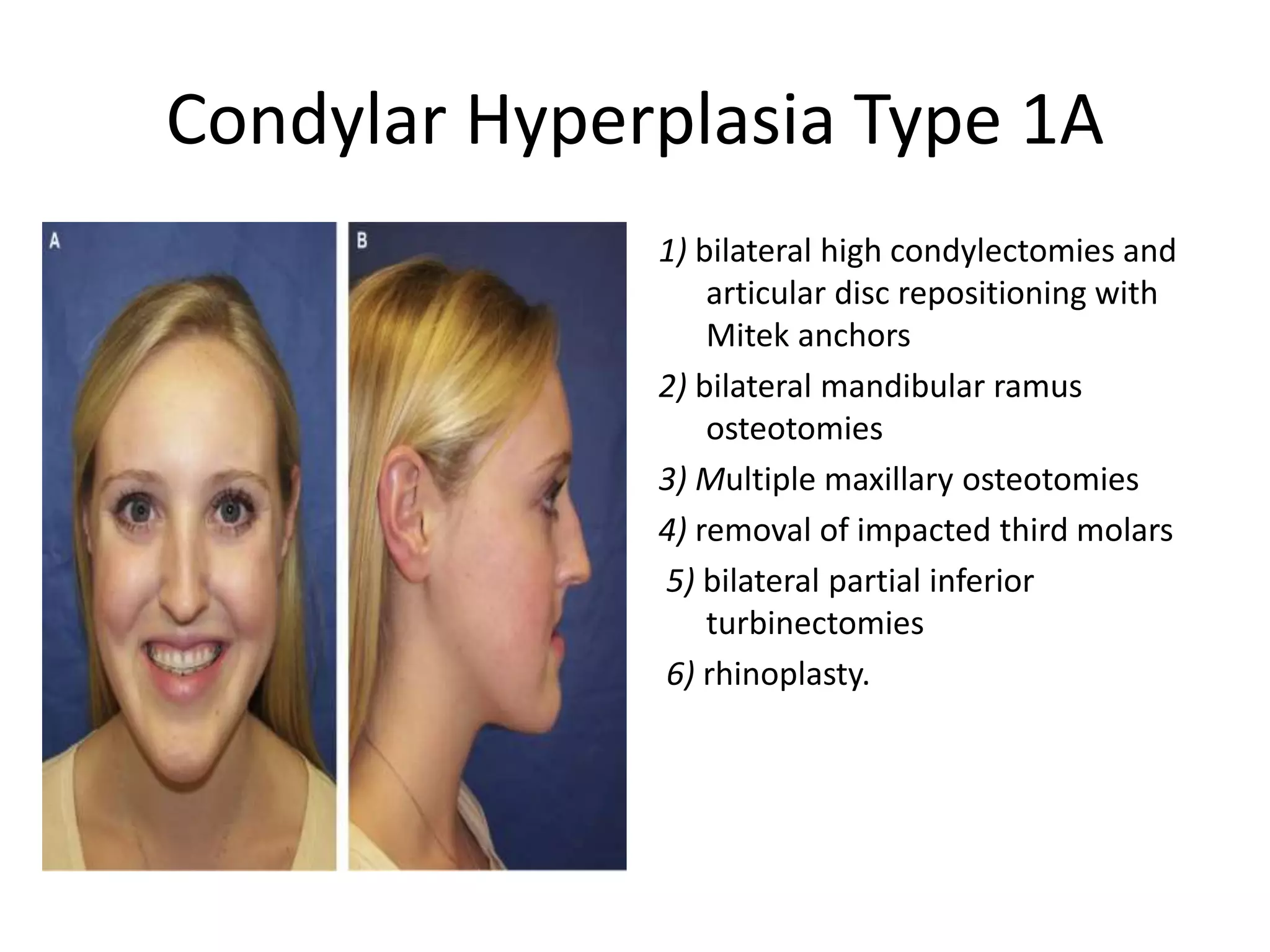 Condylar hyperplasia(ch) | PPTX