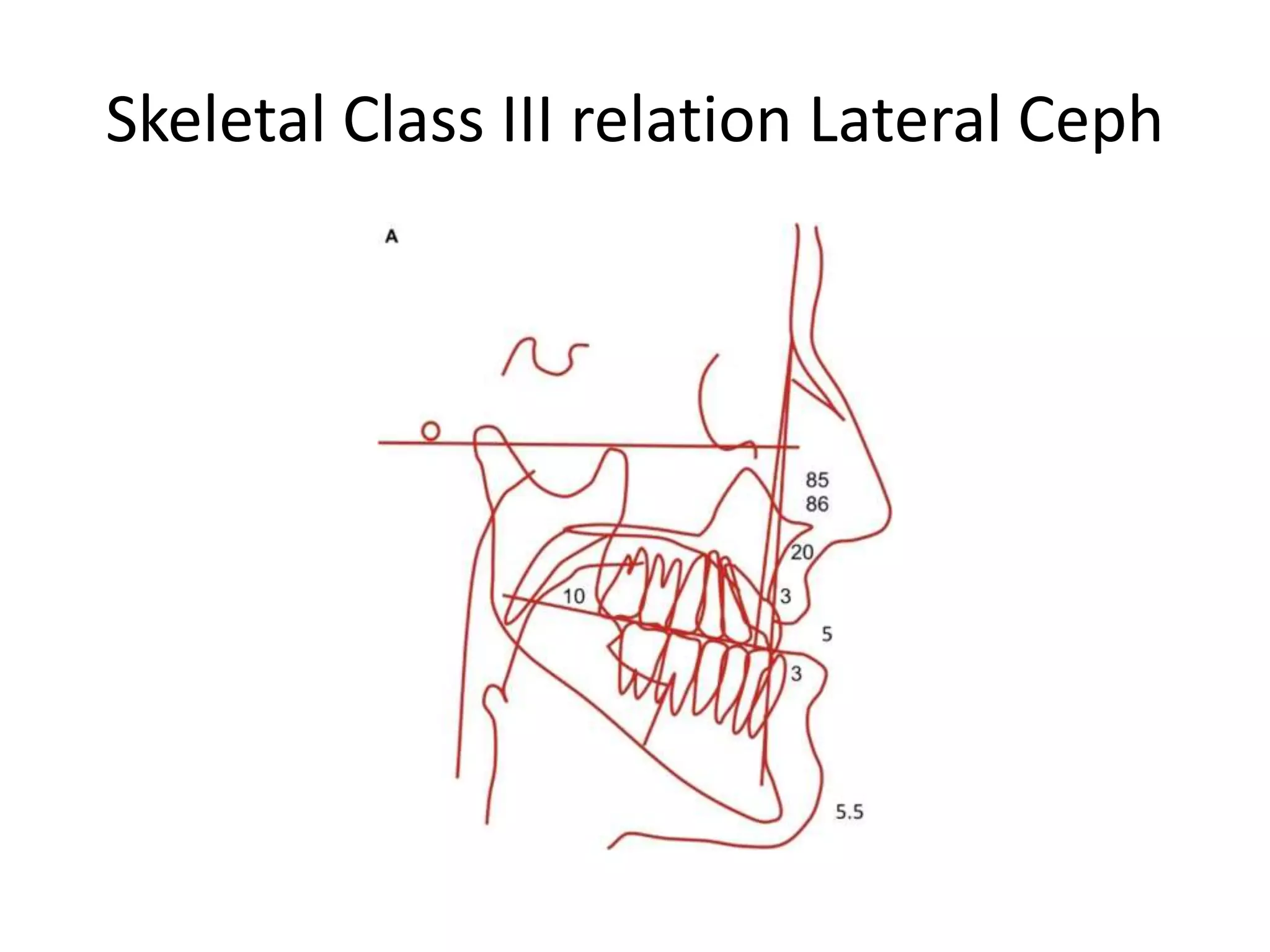 Condylar hyperplasia(ch) | PPTX