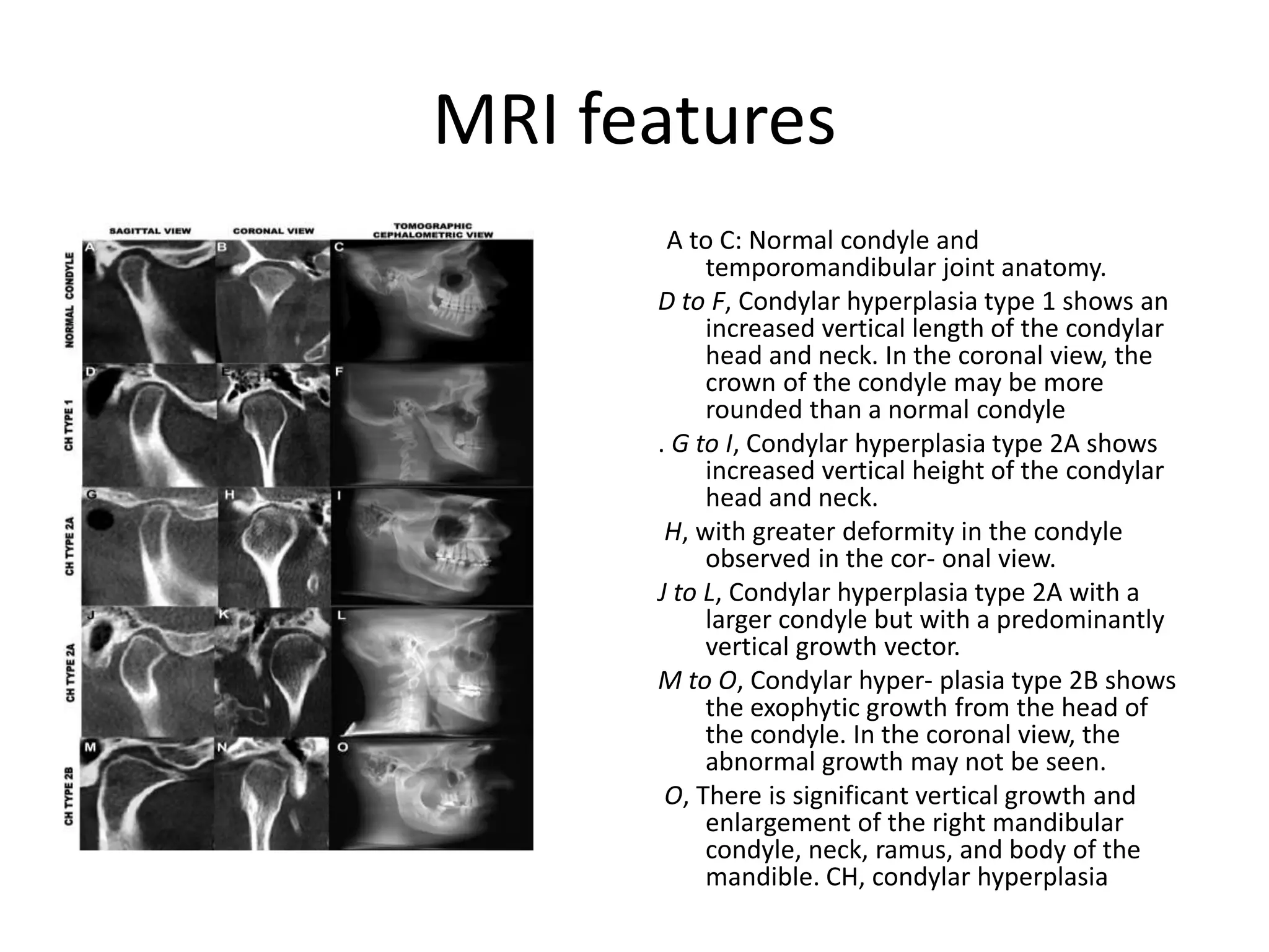 Condylar hyperplasia(ch) | PPTX