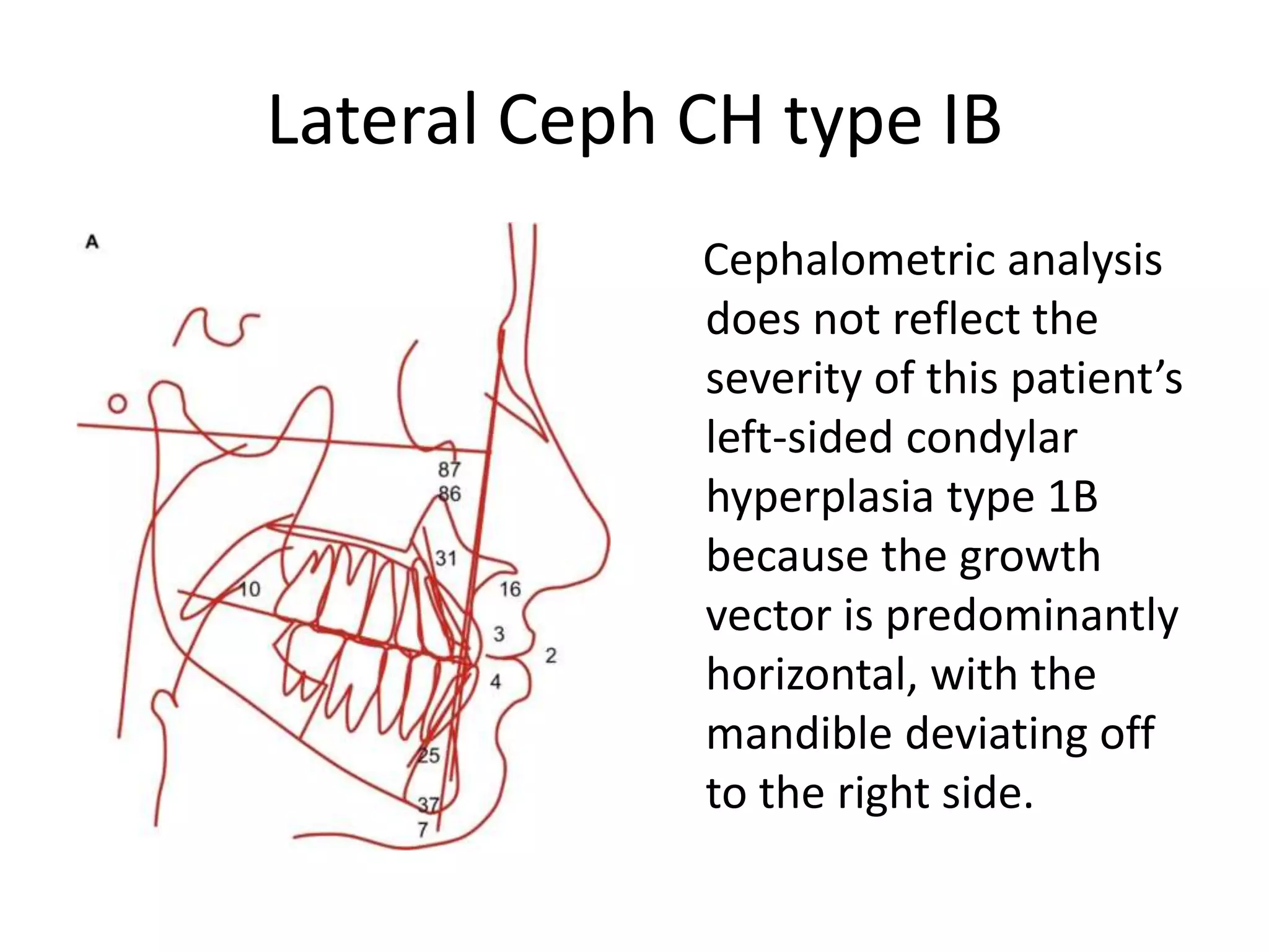 Condylar hyperplasia(ch) | PPTX