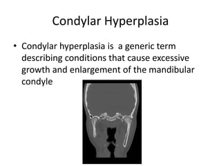 Condylar hyperplasia(ch) | PPTX
