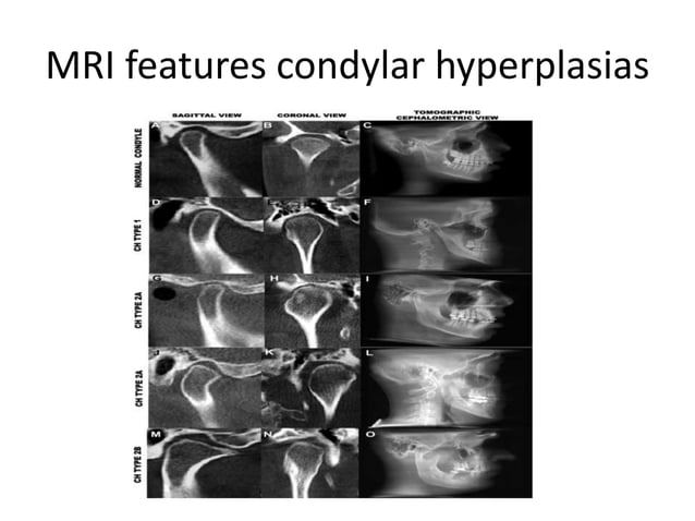 Condylar hyperplasia(ch) | PPTX | Bone and Joint Conditions | Diseases ...