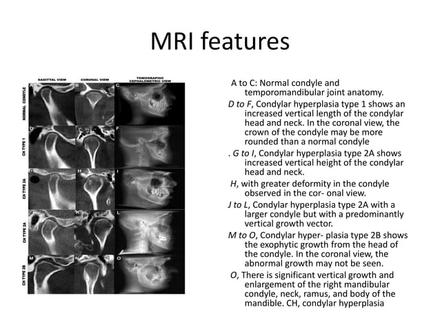 Condylar hyperplasia(ch) | PPTX | Bone and Joint Conditions | Diseases ...