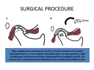 Condylar hyperplasia(ch) | PPTX