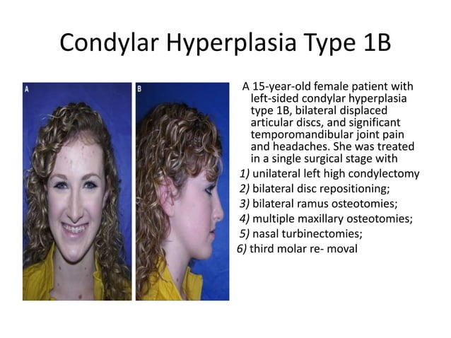 Condylar hyperplasia(ch) | PPTX | Bone and Joint Conditions | Diseases ...