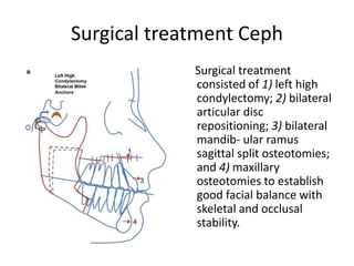 Condylar hyperplasia(ch) | PPTX