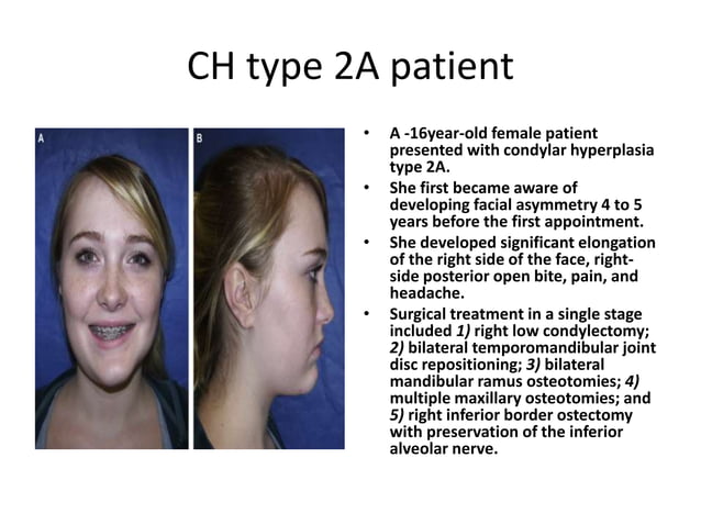 Condylar hyperplasia(ch) | PPTX | Bone and Joint Conditions | Diseases ...