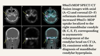 Condylar hyperplasia is a rare, benign bone disorder characterized by ...