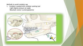Condylar resorption | PPTX