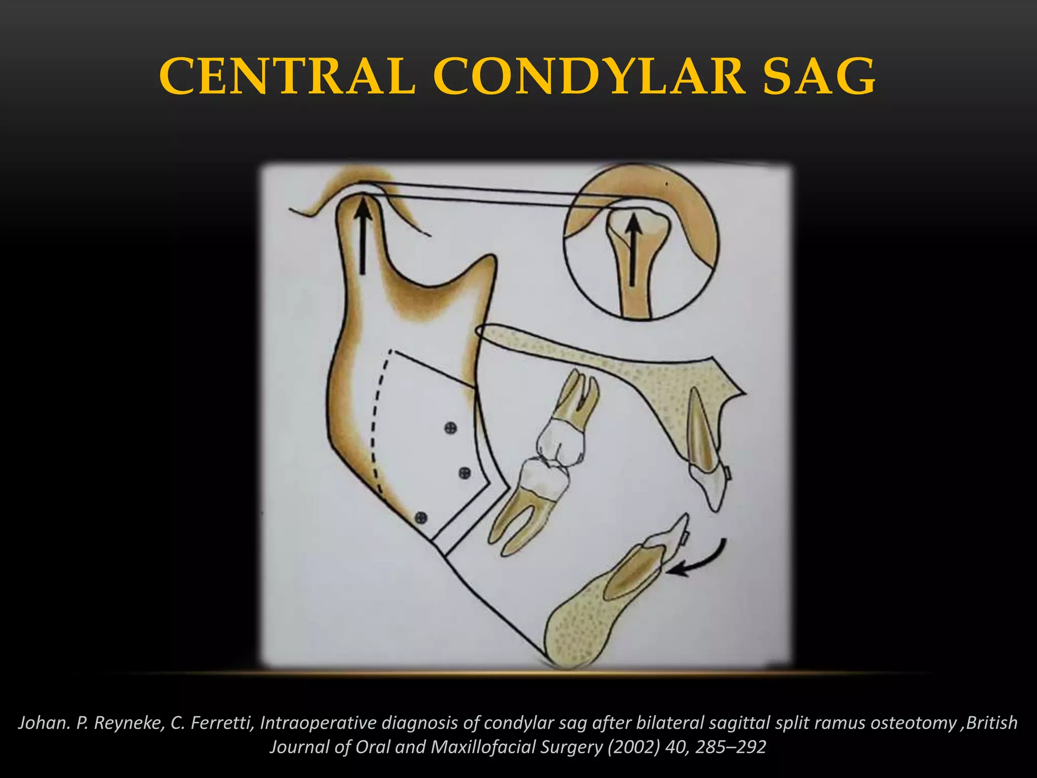 Condylar sag | PPTX