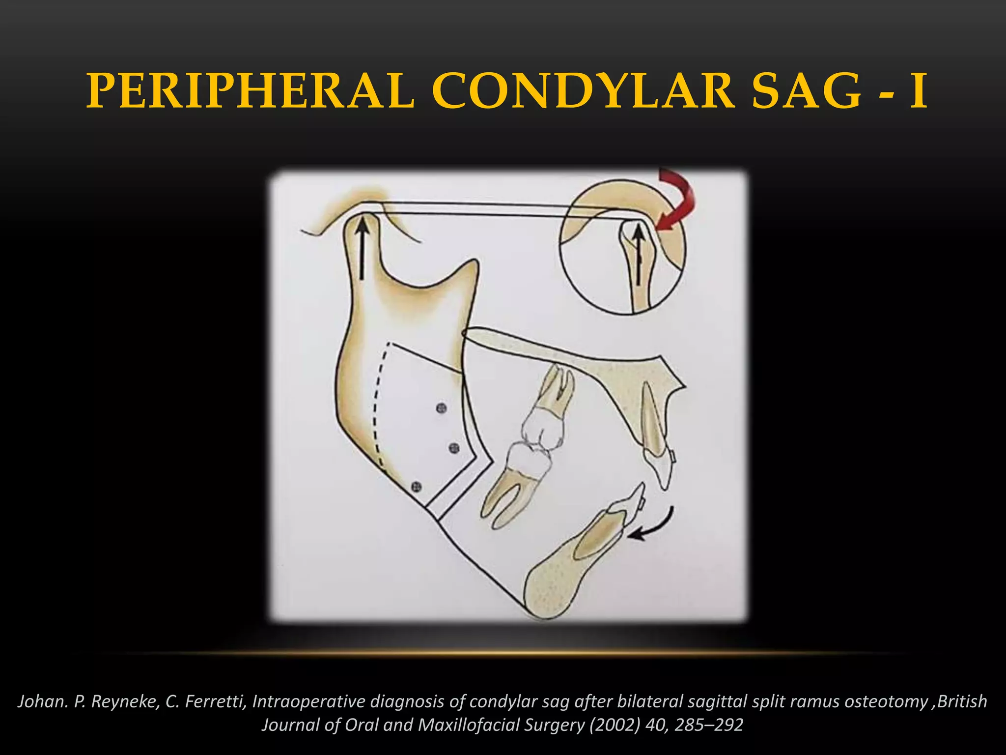 Condylar sag | PPTX