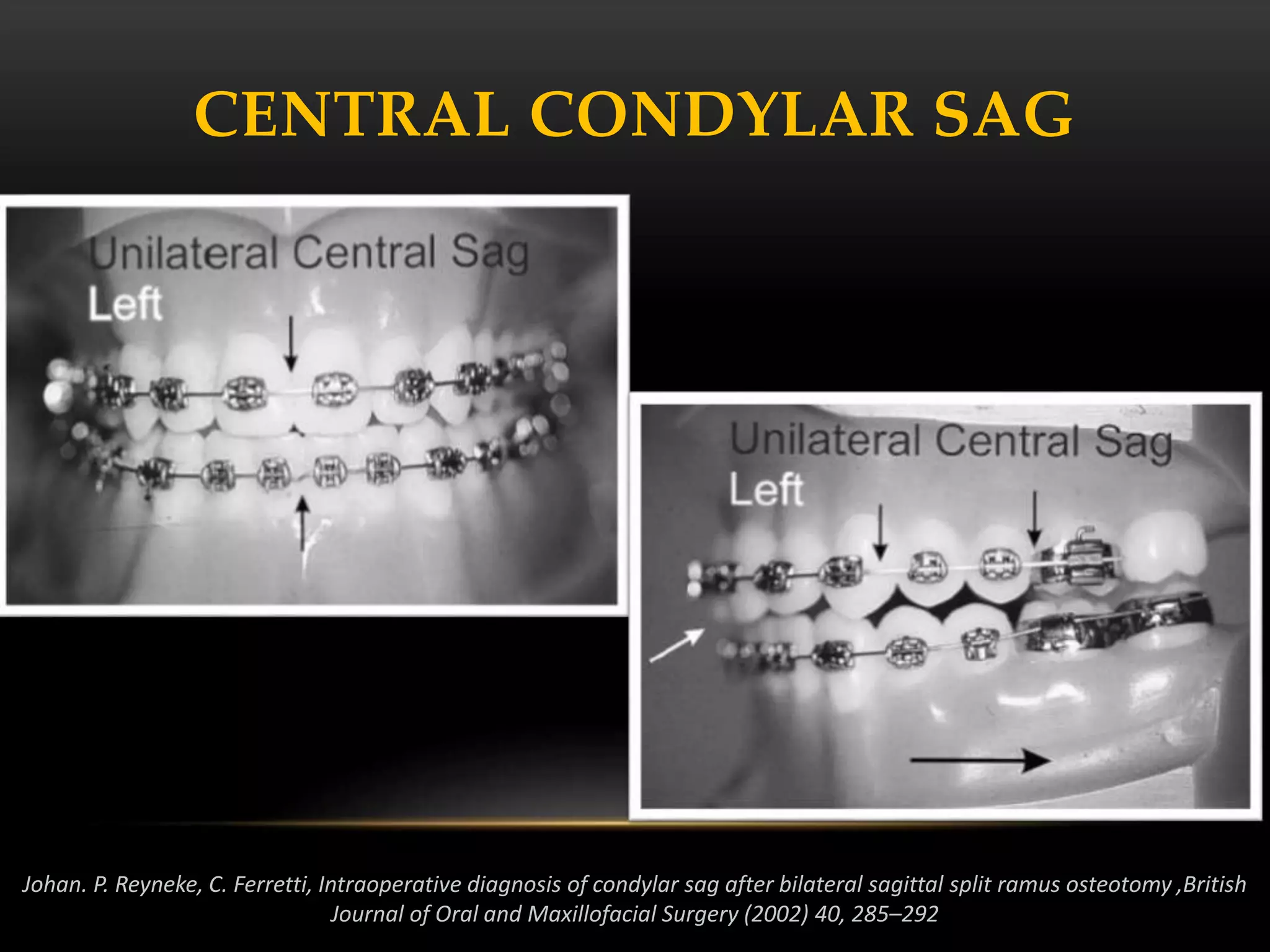 Condylar sag | PPTX