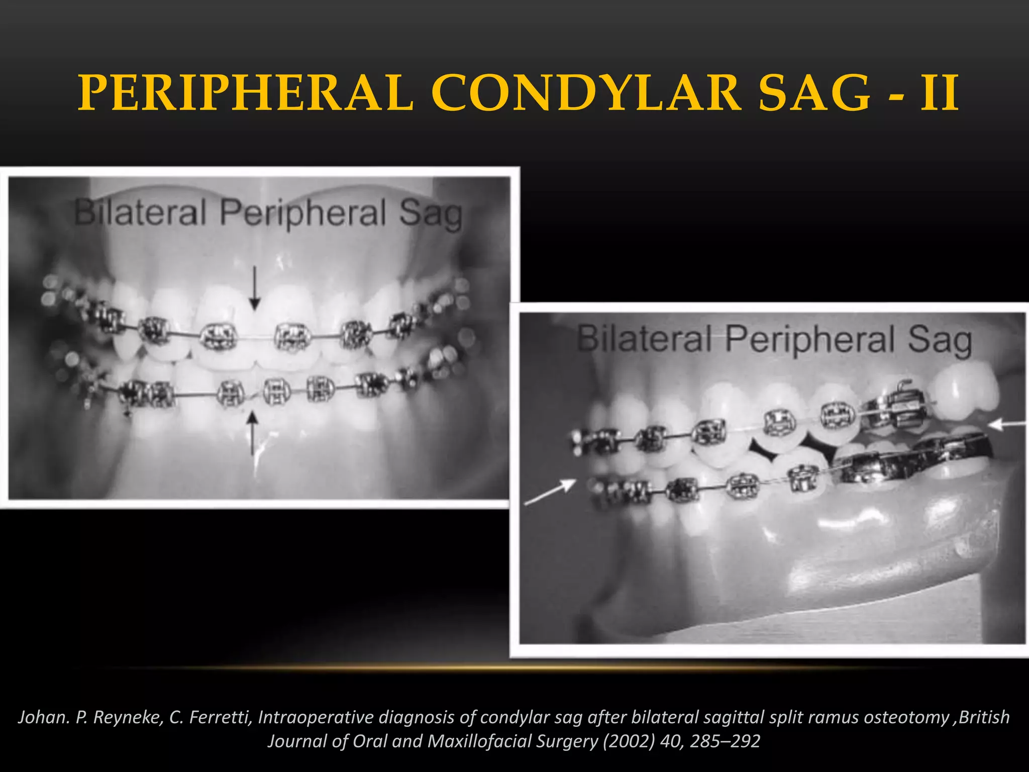Condylar sag | PPTX