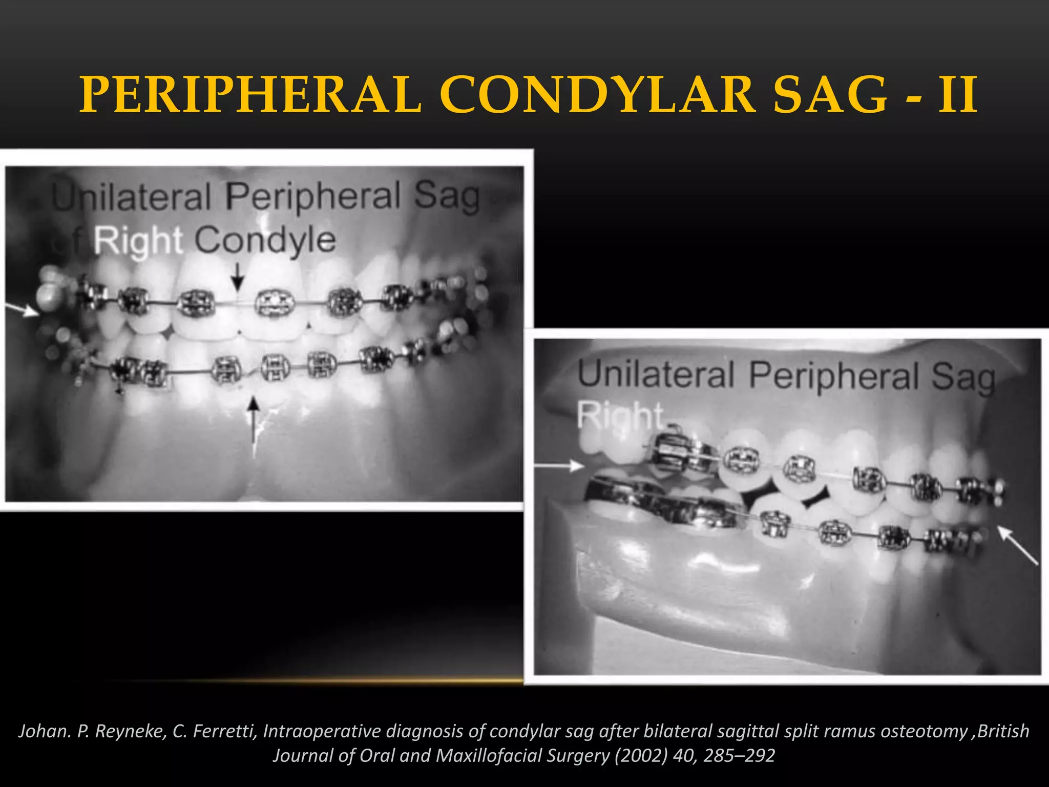 Condylar sag | PPTX