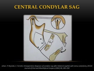 Condylar sag | PPTX