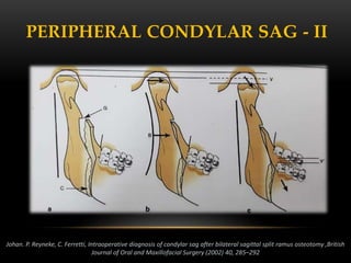 Condylar sag | PPTX