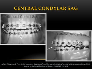 Condylar sag | PPTX
