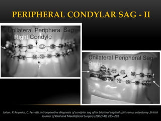 Condylar sag | PPTX