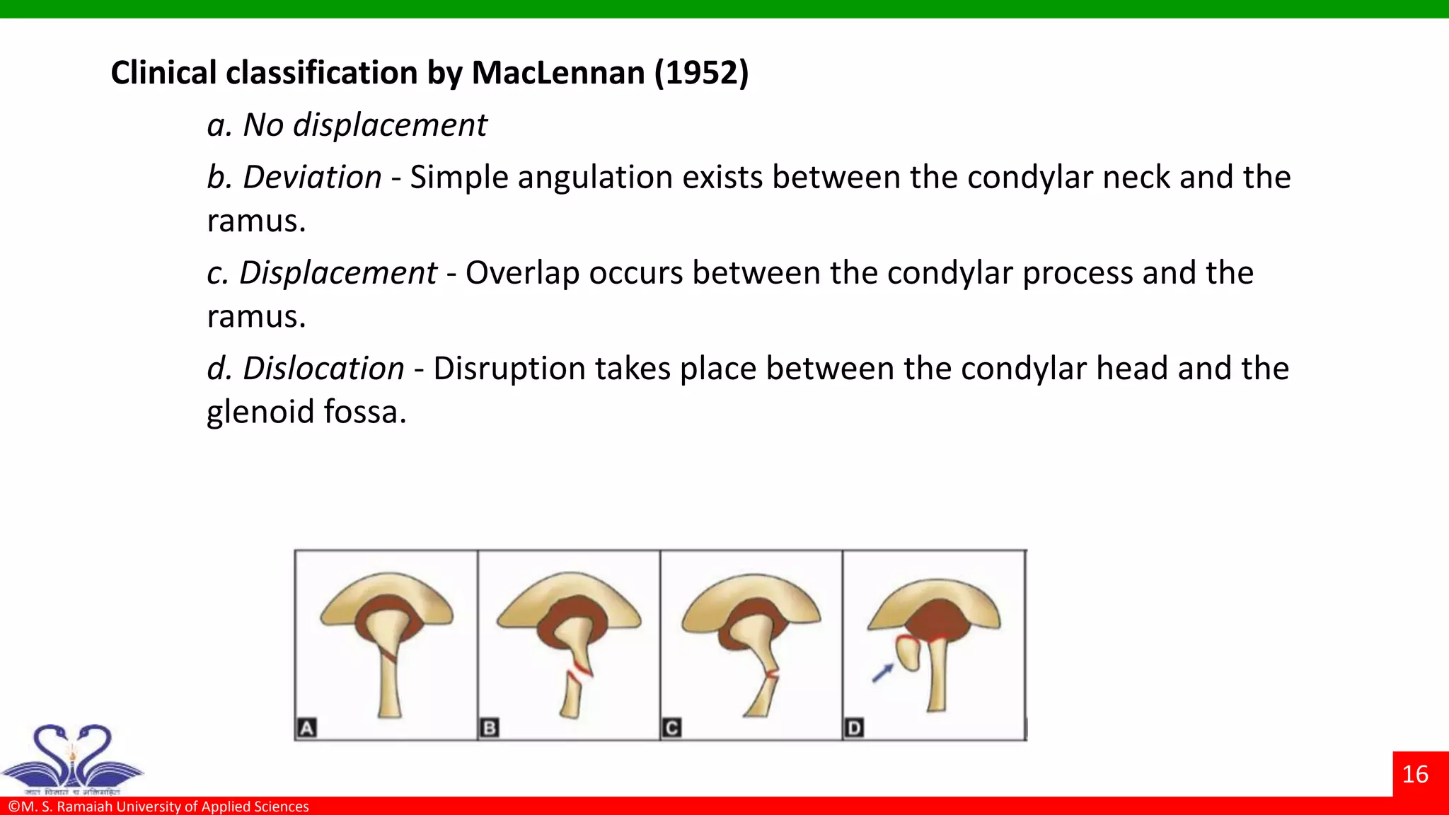 Condylar fractures | PPTX