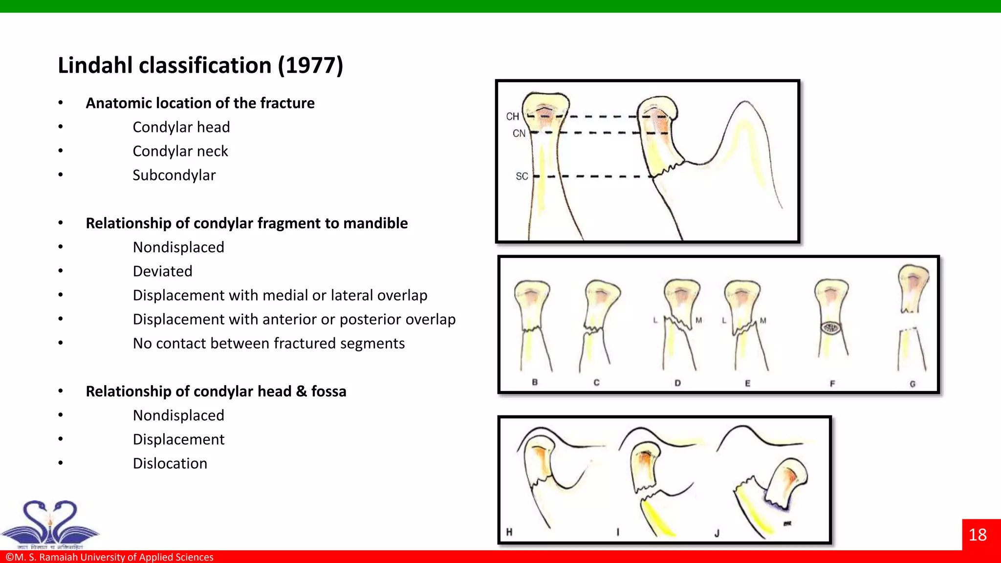 Condylar fractures | PPTX