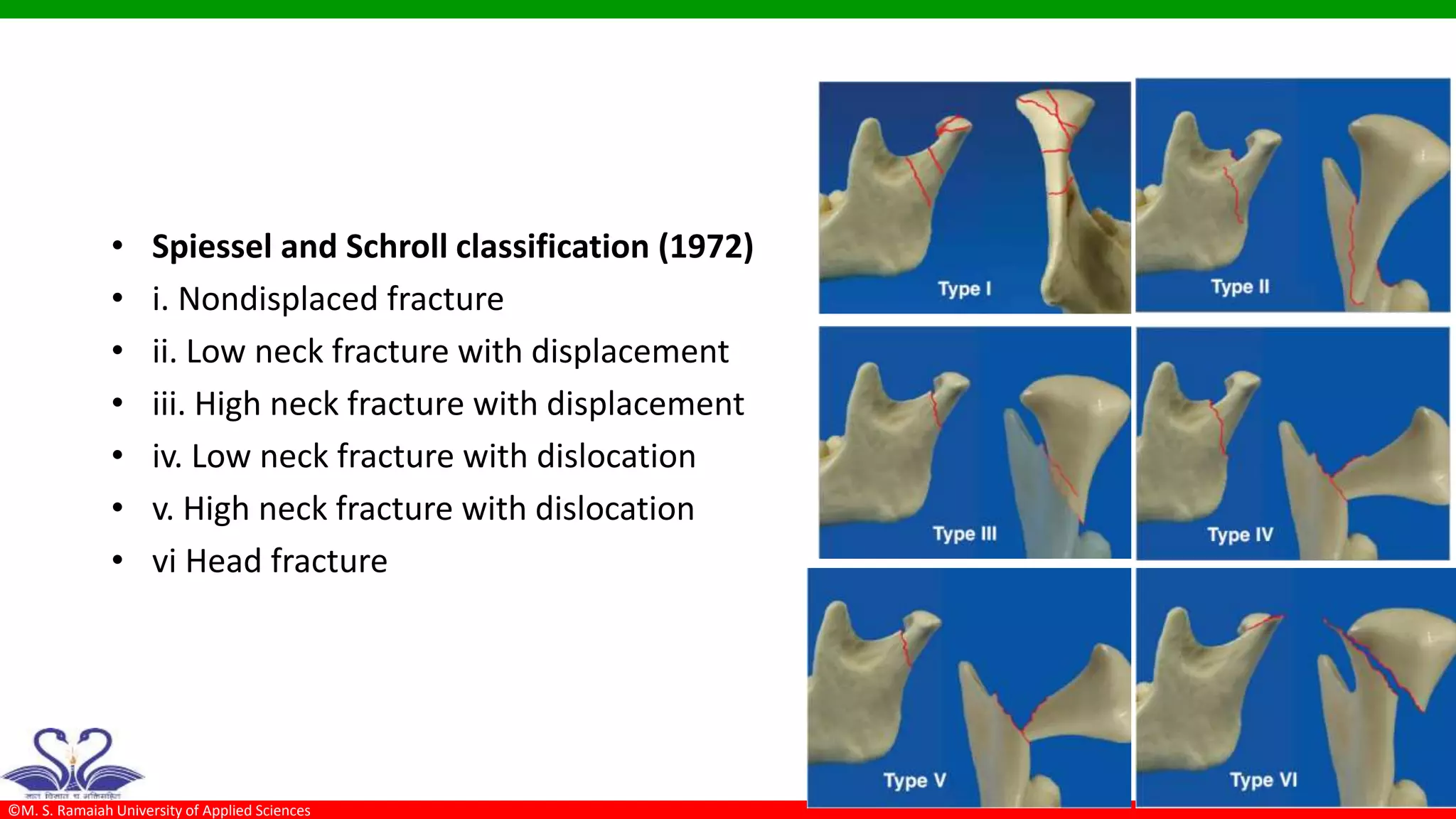 Condylar fractures | PPTX