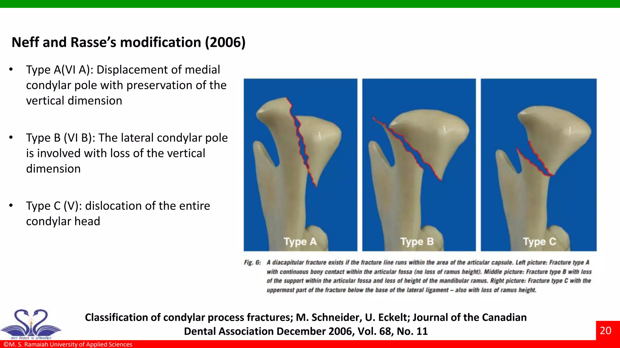 Condylar fractures | PPTX