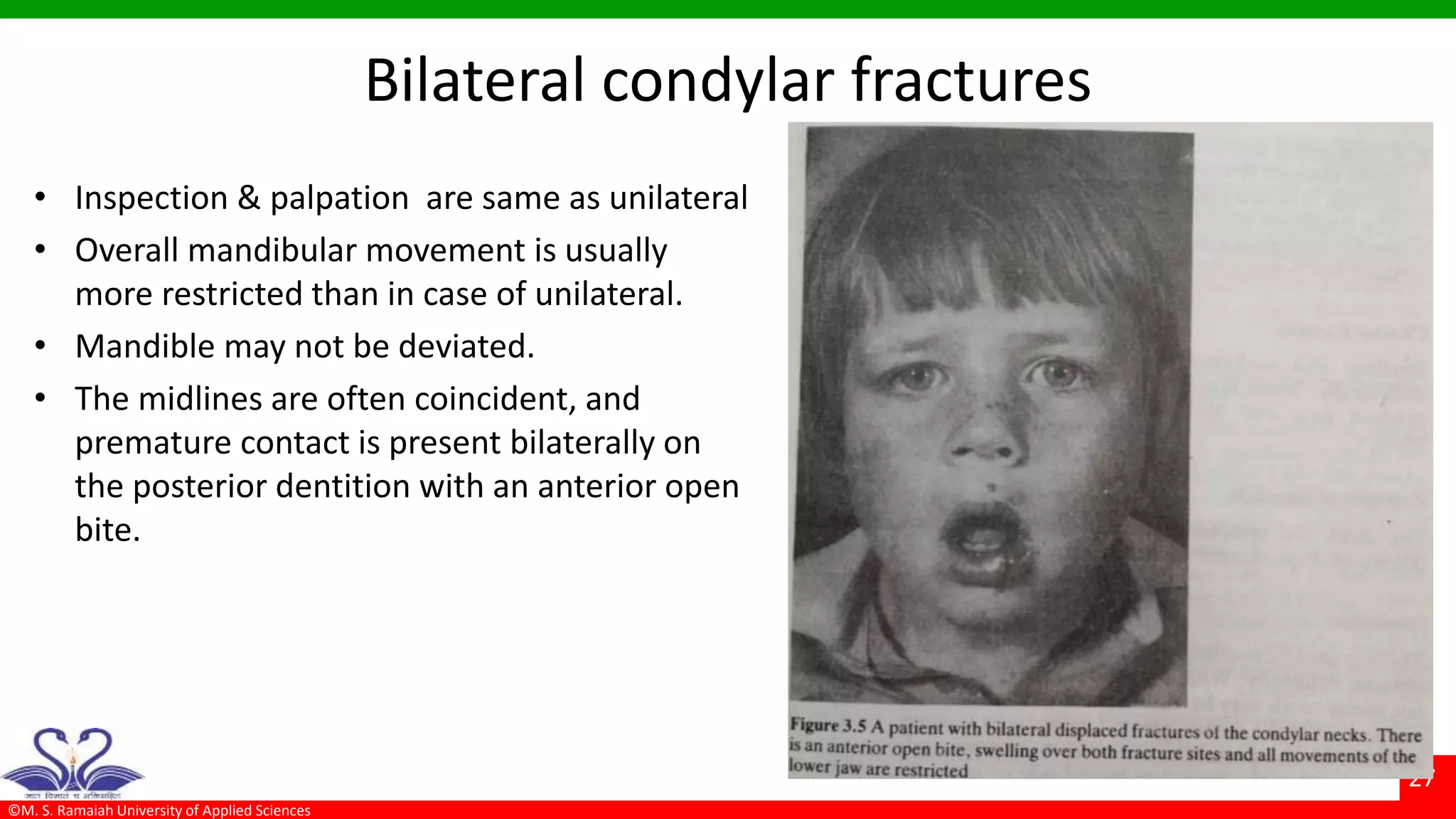 Condylar fractures | PPTX