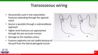 Condylar fractures | PPTX