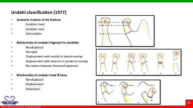 Condylar fractures