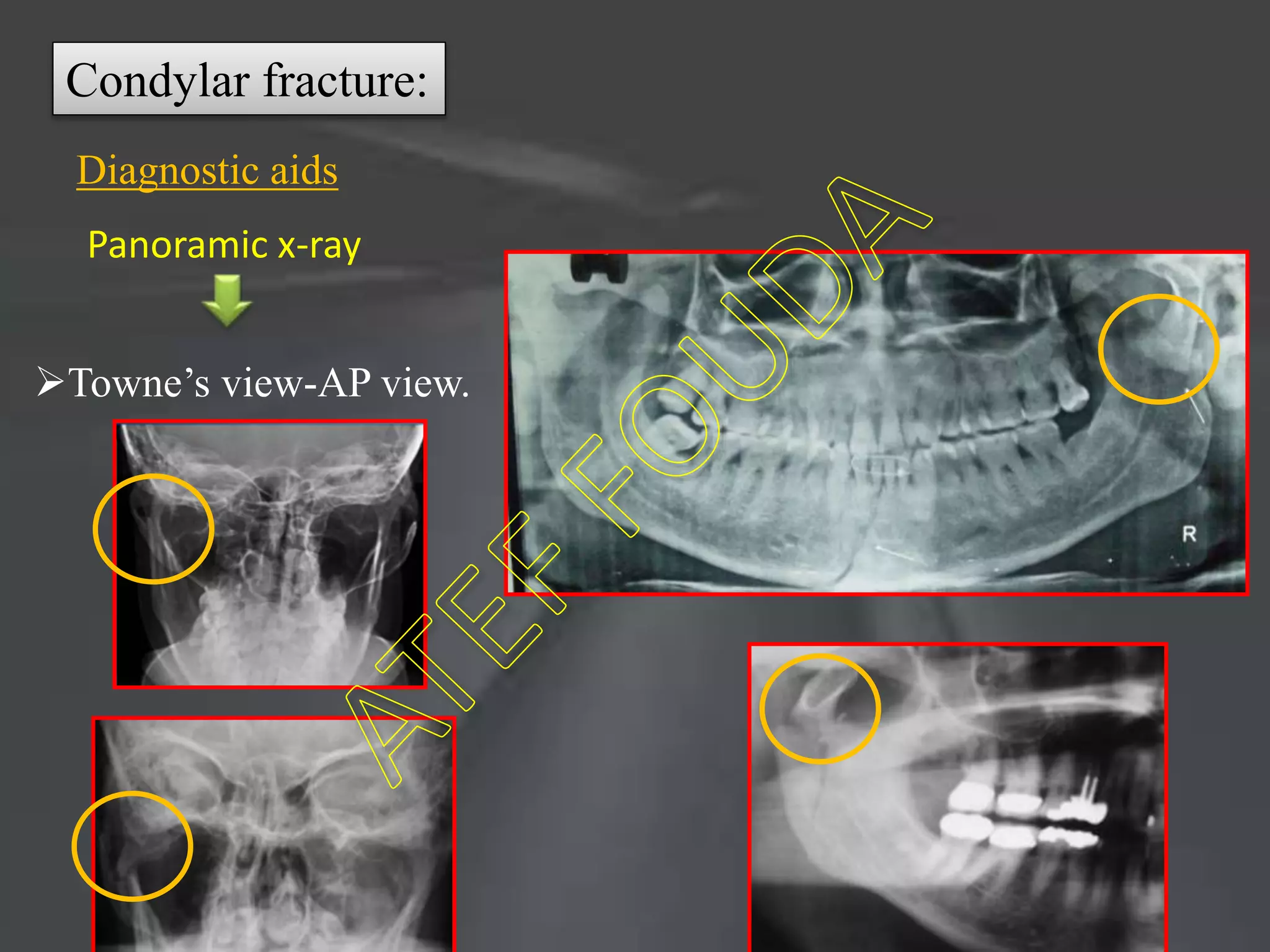 Condyle fracture | PPSX