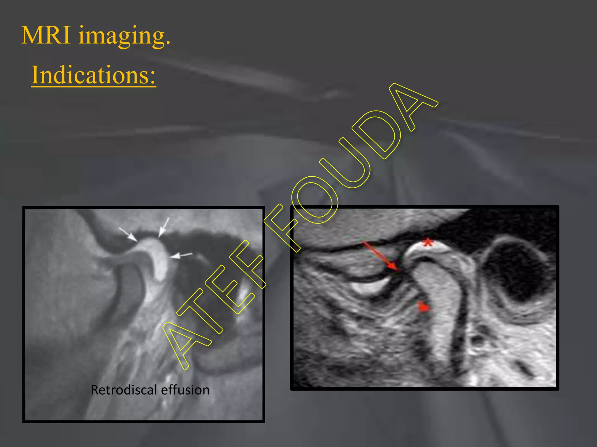 Condyle fracture | PPSX