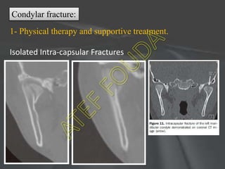 Condyle fracture | PPT