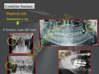 Condyle fracture | PPT
