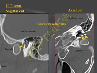 Condyle fracture | PPSX